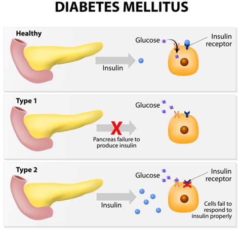 What Is Diabetes Mellitus The Snow Foundation