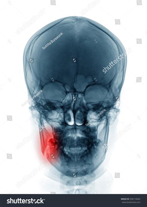 Temporal Bone Fracture Royalty Free Images Stock Photos Pictures Shutterstock