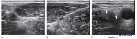 Regional Fascia Iliac Block Diagram Quizlet