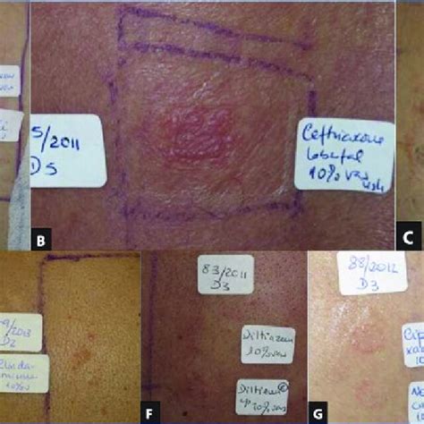 A And B Macroscopic Aspects Of Positive Patch Tests With Drugs With