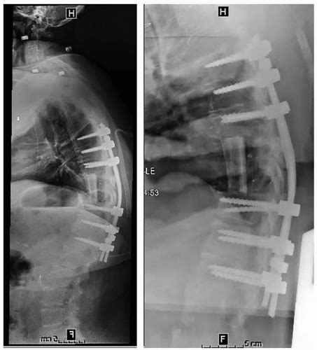 Anterior Thoracic Corpectomy And Diskectomy Musculoskeletal Key