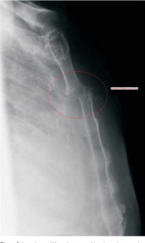 Figure 1 From Manubriosternal Subluxationdislocation Can Lead To