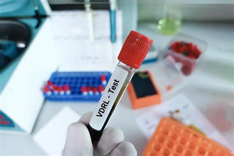 Vdrl Test Means Procedure Results And Risk Factor