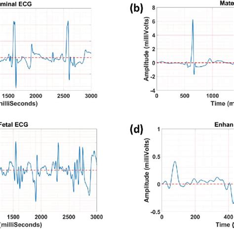 An Example Of Clinical Fetal Ecg Separation And Enhancement A Download Scientific Diagram