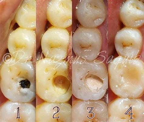 Indirect Pulp Capping With Calcium Hydroxide Mohammad N Saquib