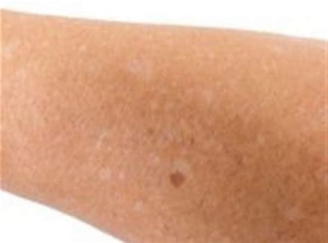 علاج تصبغ الجلد في المنزل