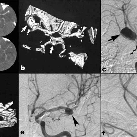 Pdf Intracranial Aneurysms Evaluation Using Cta And Mra Correlation With Dsa And
