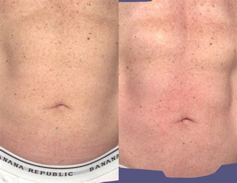 Nir Skin Tightening Beauty Medical Care