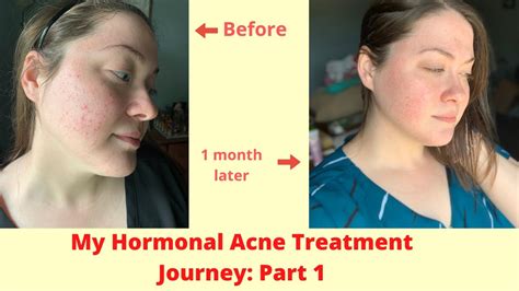 Acne Skin Care Routines Drugstore Doxycycline Side Effects Youtube