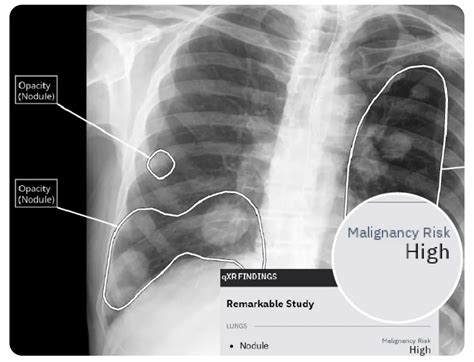 Qureai Nets Fda Clearance For Ai Powered Chest X Ray Lung Nodule Solution Applied Radiology