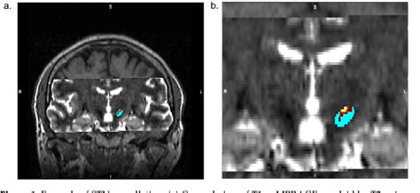 Figure 1 From Imaging Modalities Used For Frameless And Fiducial Less