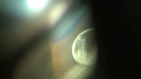 Paul­® Glaucoma Implant Dr Paul Chew