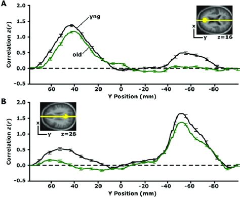 Reduced Functional Correlations Observed Anatomically A The Time