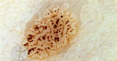 Dermnet® Dermoscopy Image