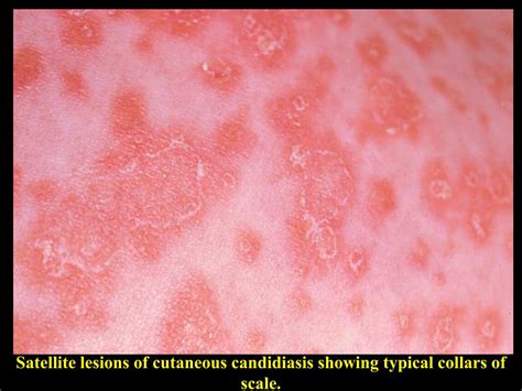 Candida Diaper Rash Satellite Lesions At Maria Baum Blog