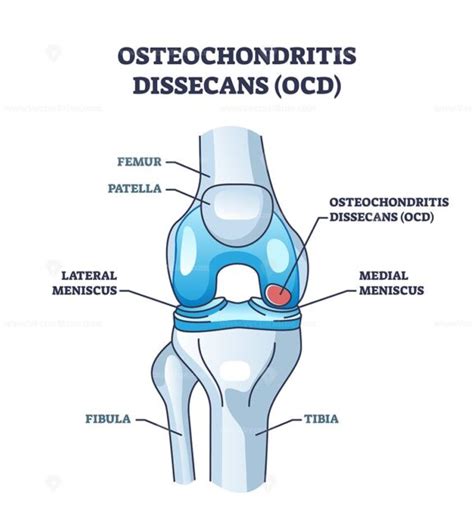 Osteochondritis Dissecans Or Ocd Bone And Cartilage Condition Outline Diagram Vectormine