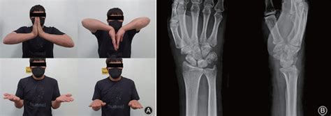 A Novel Surgical Technique For Neglected Volar Dislocation Of The Lunate Cases Report And
