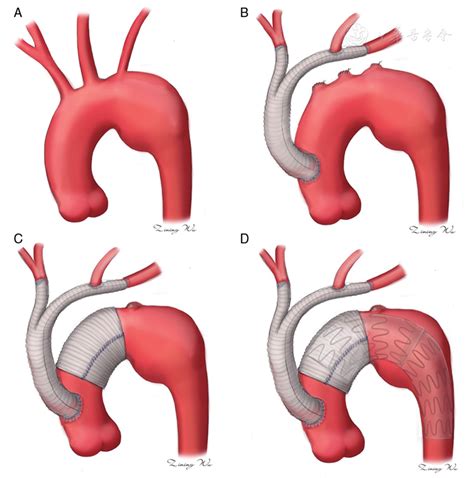 Debranching Thoracic Endovascular Aortic Repair Combined With Ascending Aortic Aortoplasty