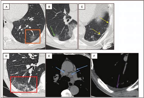 Top 3 Typical And Atypical Ct Findings A Nodular Ground Glass Download Scientific Diagram