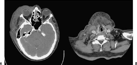 Axial Computerized Tomographic Scans With Contrast Medium Of The Head Download Scientific