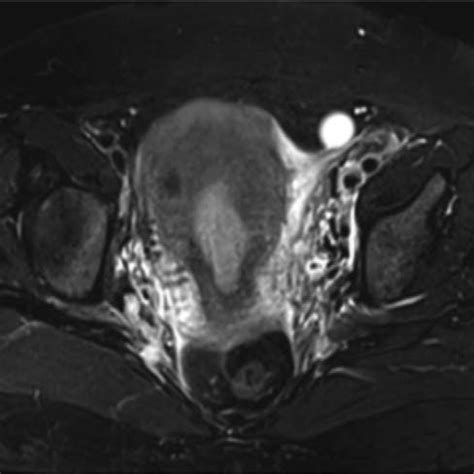 Magnetic Resonance Imaging Scan Showing Normal Bladder And Cervix Download Scientific Diagram