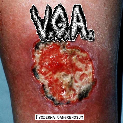 Pyoderma Gangrenosum Violently Gutted Alive