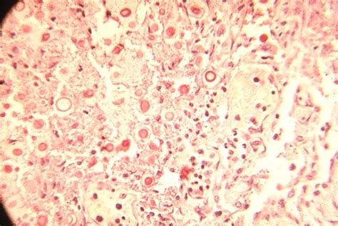 Cryptococcus Infection Symptoms Cryptococcosis Symptoms Causes And Treatment Of Fungal