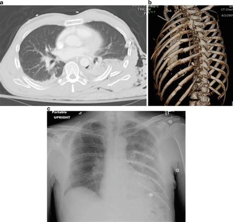 Indications For Operative Management Of Flail Chest Injuries Thoracic Key