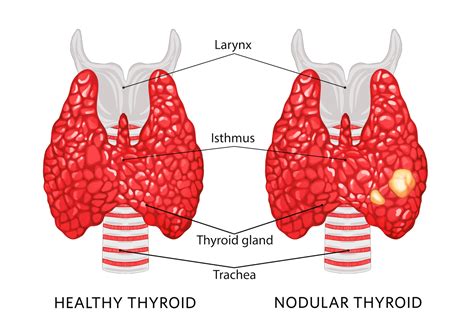 Thyroid Ablation Breakthrough Non Surgical Treatment
