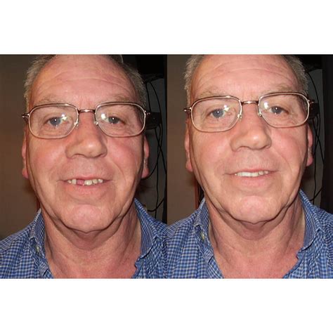 Temporary Tooth Replacement Kit 100 Money Back Guarantee Temptooth