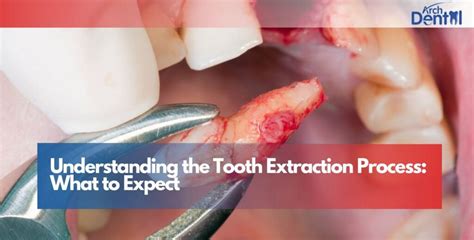 Understanding The Tooth Extraction Process Arch Dental