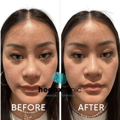 Asymmetrical Nose Pictures