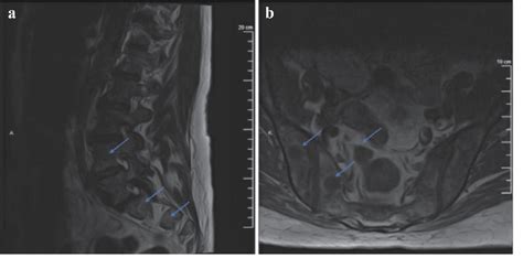 Figure 4 From Extramedullary Myeloid Leukemia In The Setting Of A Myeloproliferative Neoplasm