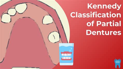 Removable Partial Denture Kennedy Classification At Anna Waldron Blog Removable Partial Denture Kennedy Classification At Anna Waldron Blog