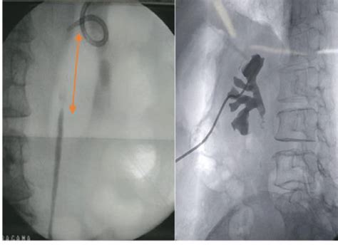Retrograde And Antegrade Pyelogram Showing Long Left Upper Ureteric Download Scientific Diagram