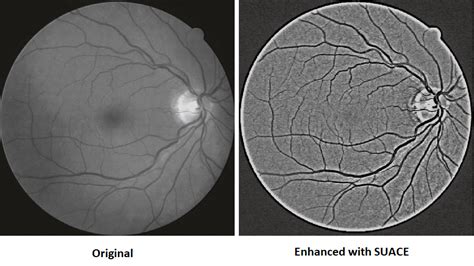 Dr Ravimal Bandara A Fast Simple And Powerful Contrast Enhancement