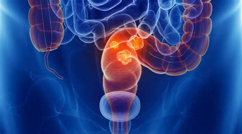 Rectal Cancer Specialists In Chennai Kkr Hospital