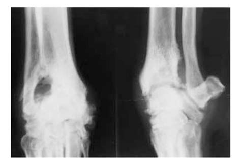 Nine Months After Diagnosis The Radiocarpal Joint Showed Signs Of