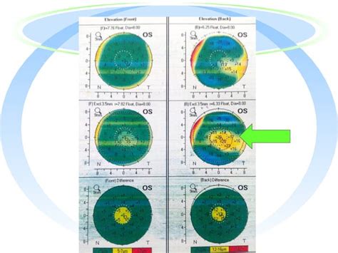 Early Keratoconus Detection Ppt
