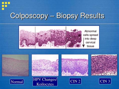 Ppt Management Of Abnormal Pap Smears And Cervical Dysplasia