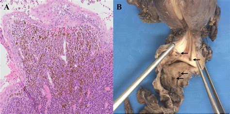 A The Original Vaginal Polyp Showed Confluent Stromal Epithelial Download Scientific Diagram