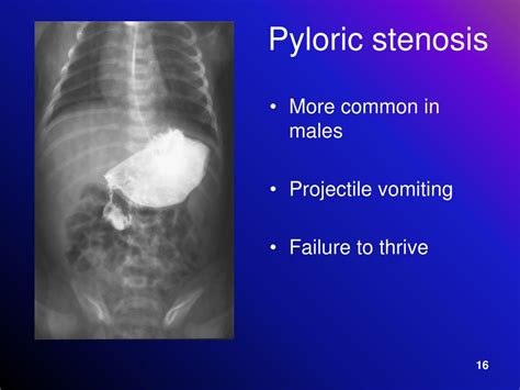 What Causes Projectile Vomiting In Pyloric Stenosis At Tracy