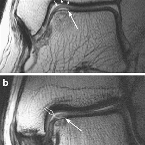 A Grade 1a Osteochondral Lesion Medial Central Talar Dome Download Scientific Diagram