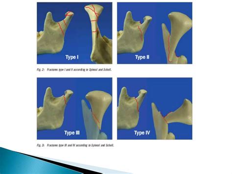 CONDYLAR FRACTURE Pptx