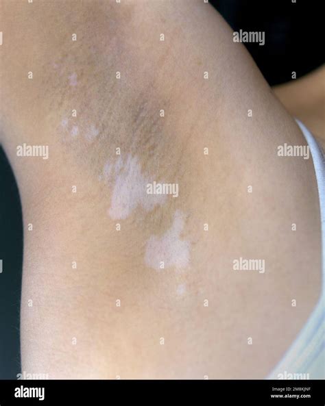 Close Up Of Several White Vitiligo Skin Patches In The Right Armpit Of