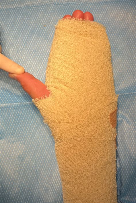Having An Open Fasciectomy Fife Virtual Hand Clinic