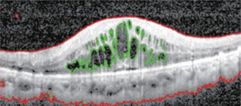 Comparison Of Segmentation Performance Of Macular Edema Between The Download Scientific Diagram