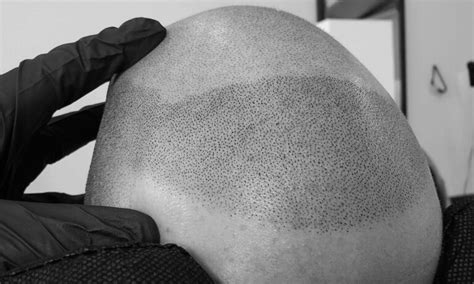 Answering Your Faqs About Scalp Micropigmentation