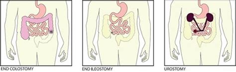 Colostomy Vs Ileostomy