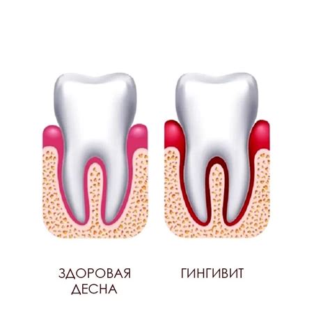 Лечение гингивита у детей